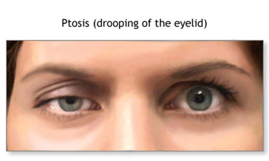Oculoplasty Treatment - Dr. Shyam Agrawal - Agarwal Eye Hospital