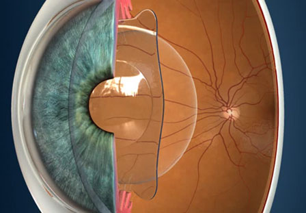Phakic intraocular lens and ICL - Dr. Shyam Agrawal - Agarwal Eye Hospital